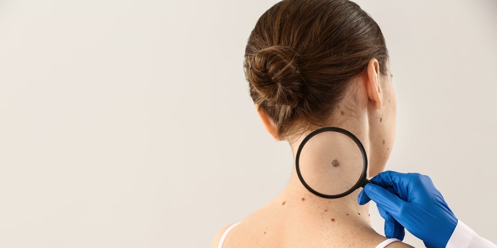 Qué es la regla ABCDE para la detección precoz del cáncer de piel